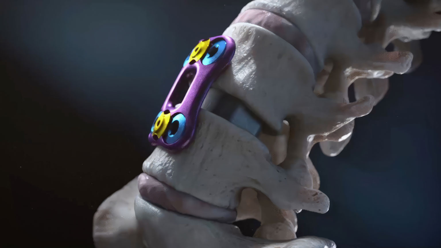 Spinal Implant Medical Device | Image