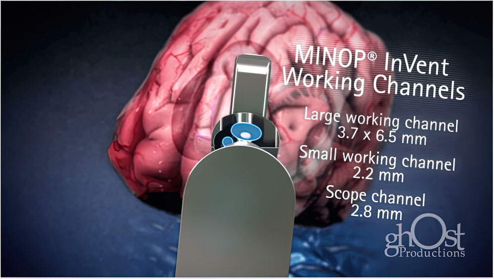 Minop InVent Device | Image