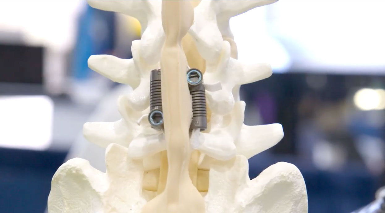 "LimiFlex's Dynamic Sagittal Tether™ Revealed at NASS 2023"