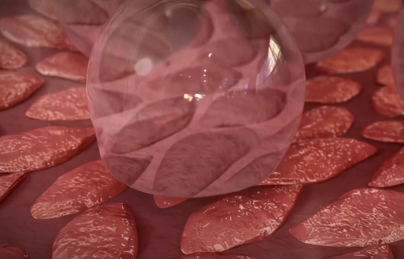 VenaSeal Closure System for Superficial Vein Therapies | Video