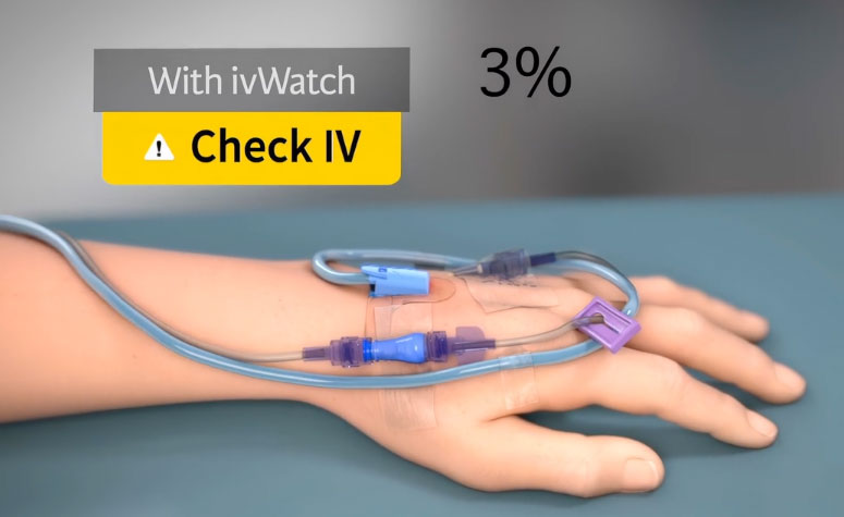 IV Watch - Early Detection of IV infiltration | Animation 2018 | Video
