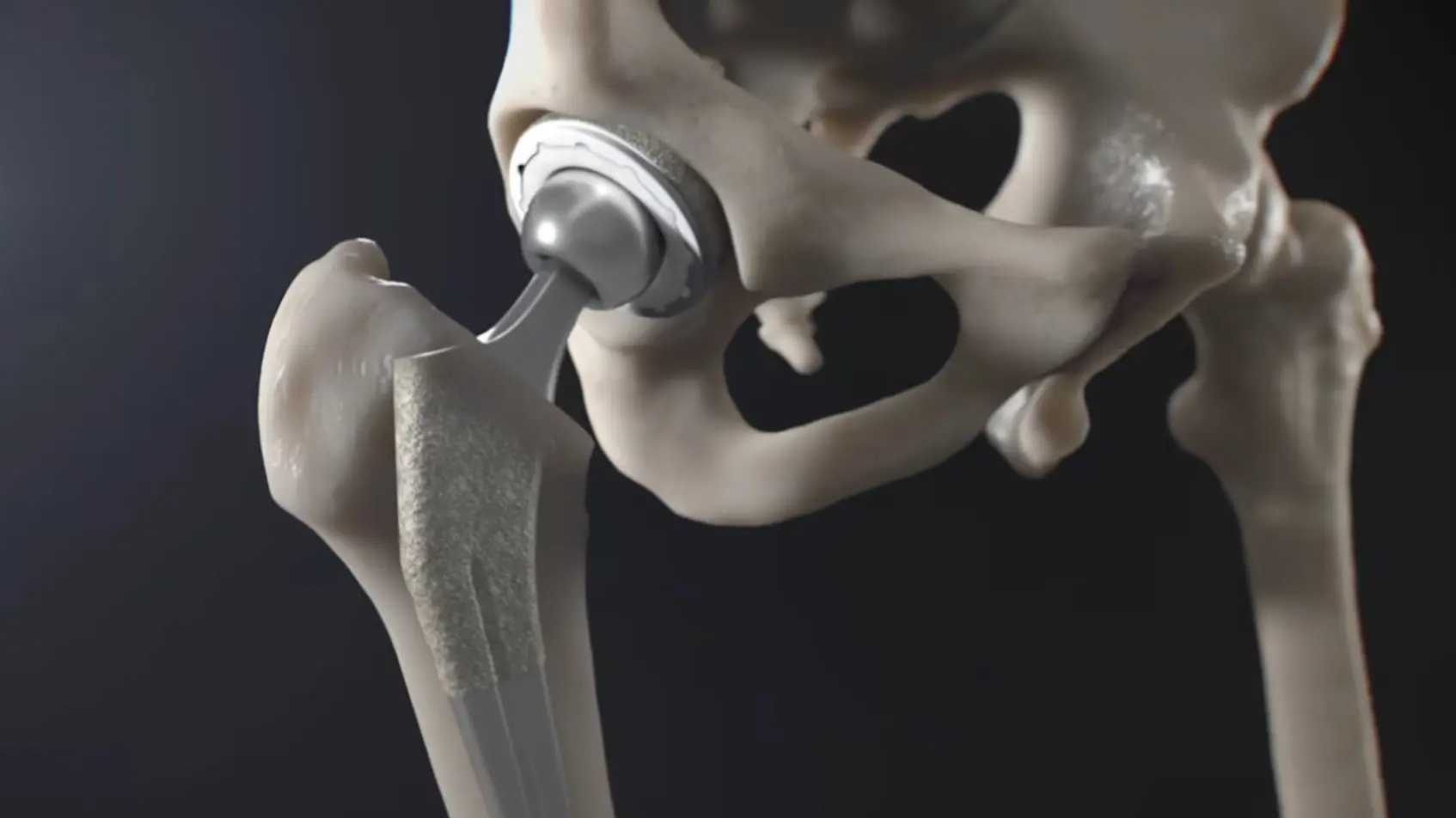 Orthopedic, Sports Medicine, Joint & Trauma animation | Ghost Medical