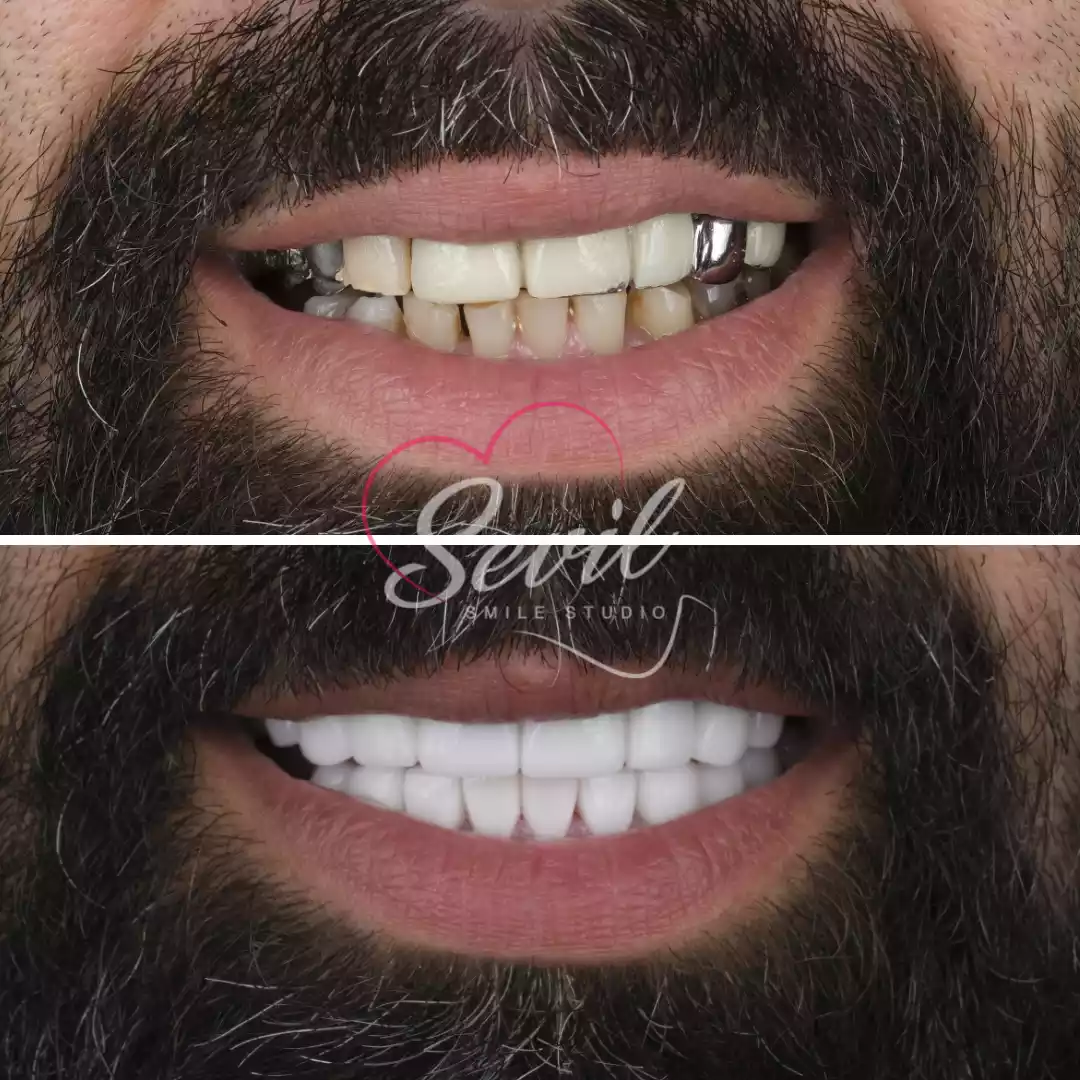 Sevil Smile Studio | SEVIL PEARLY OFF SCALE WHITE® FULL VENEER ...