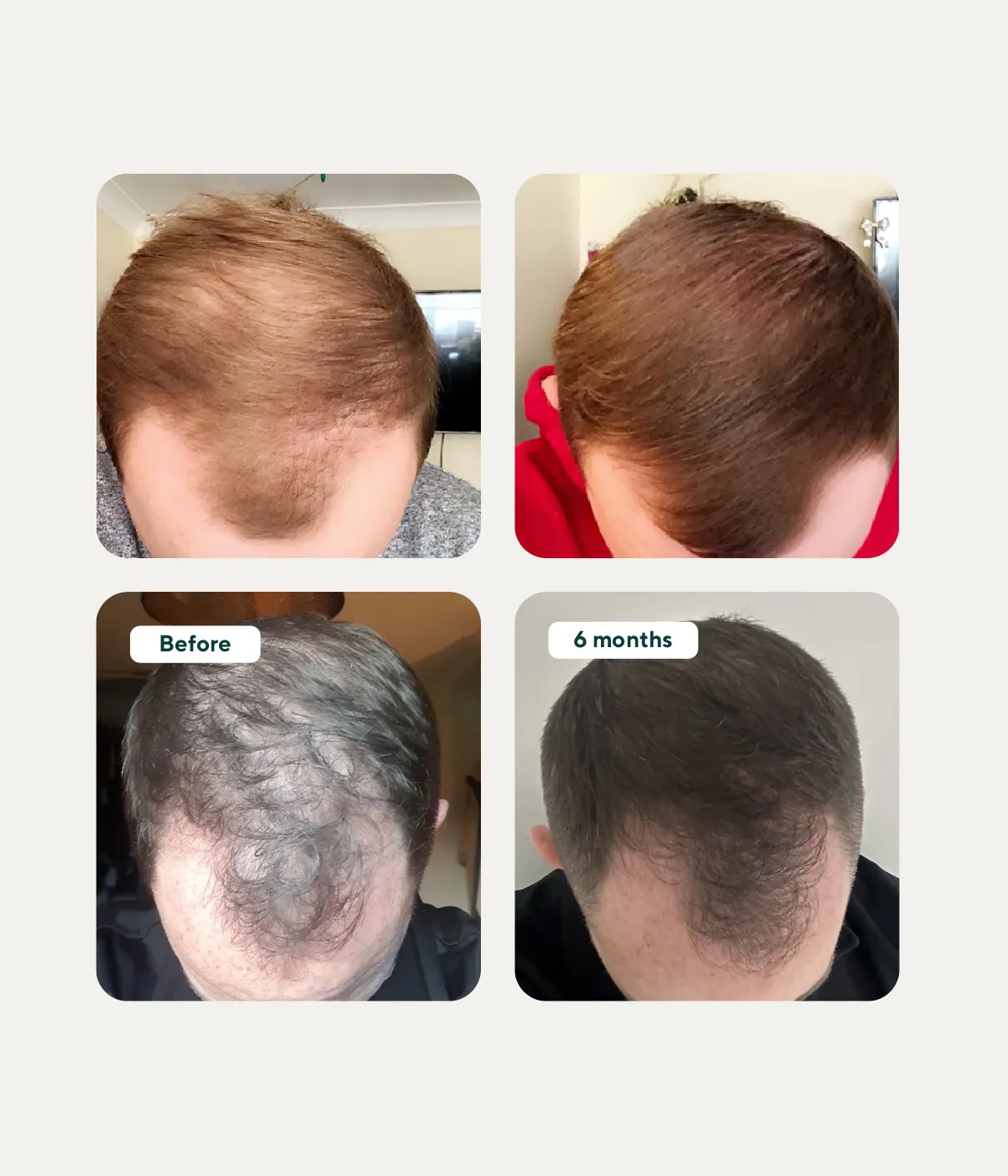 Hair Loss Tablets | Men's Hair Regrowth Treatment | MANUAL