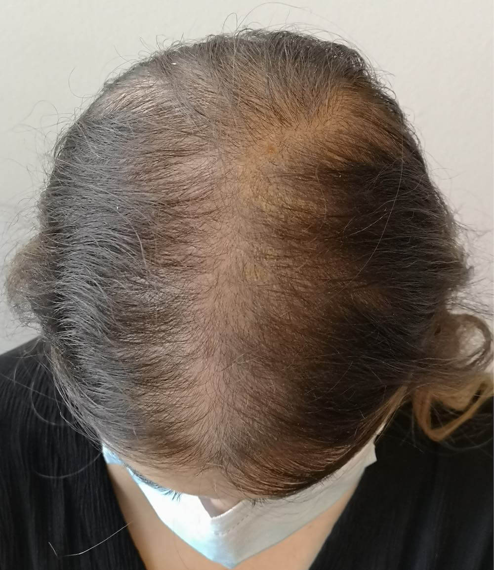 Deine Spezialisten für Haarausfall | Haarklinik Zürich
