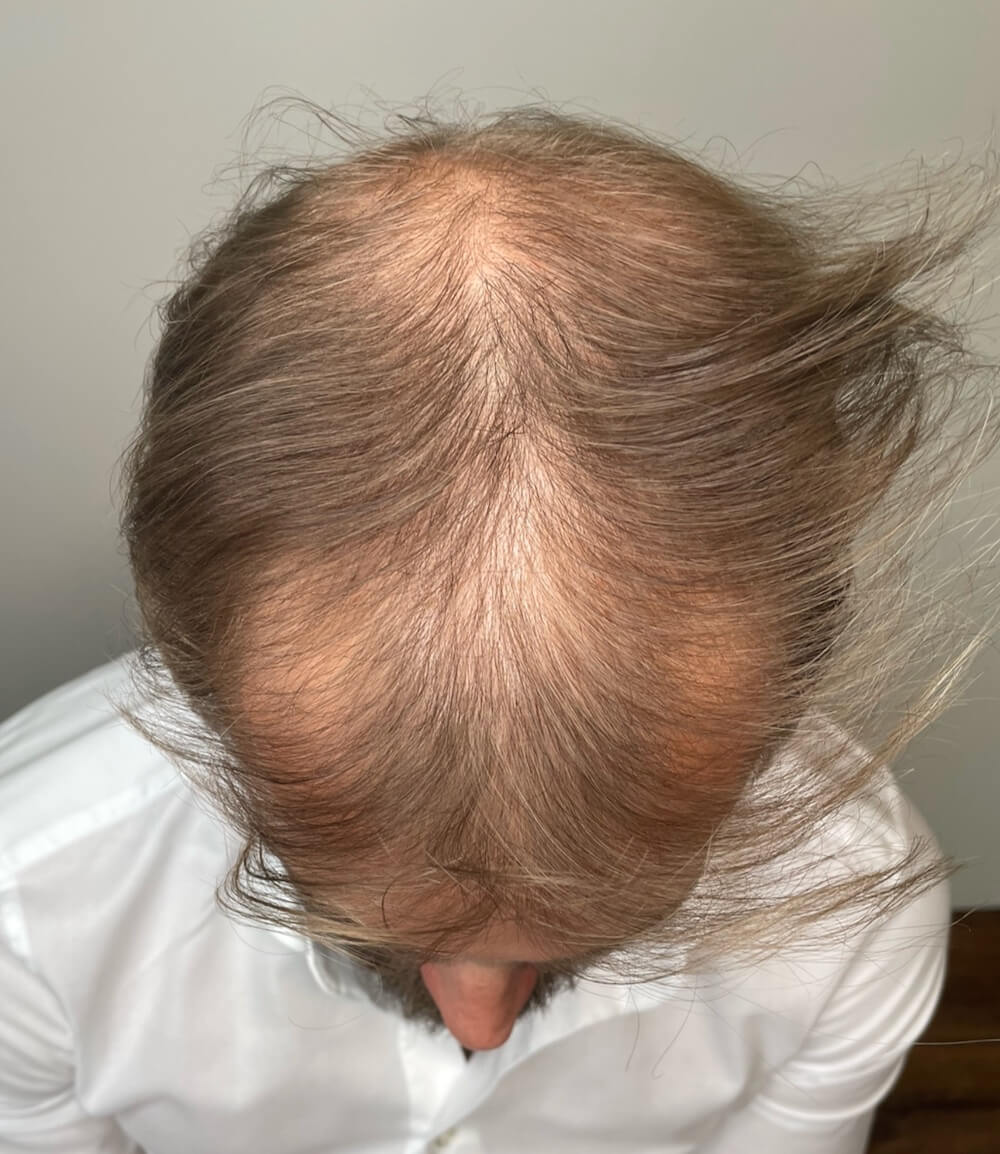Deine Spezialisten für Haarausfall | Haarklinik Zürich