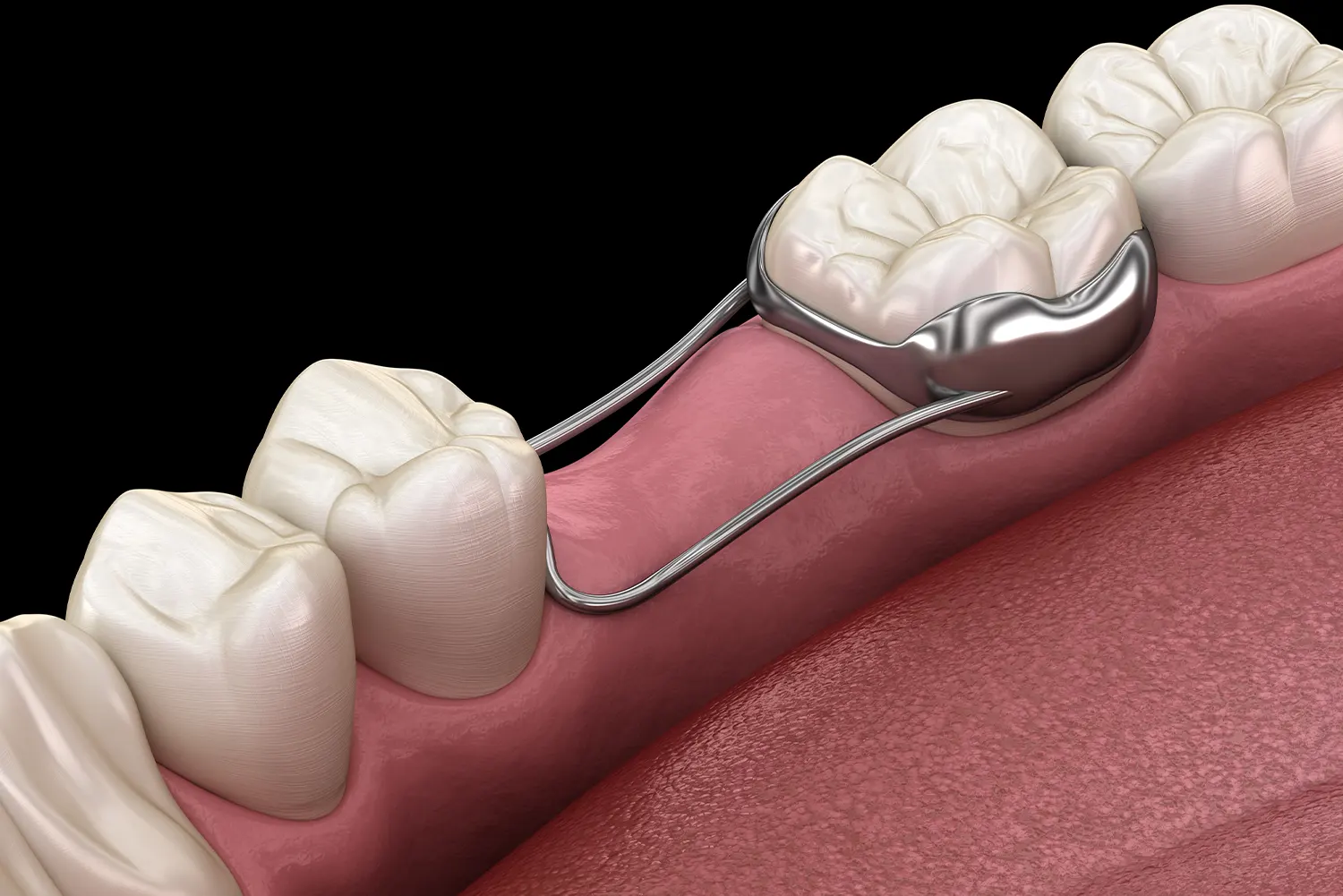 Space Maintainers in Worthington, OH | Victoria Hutta Orthodontics