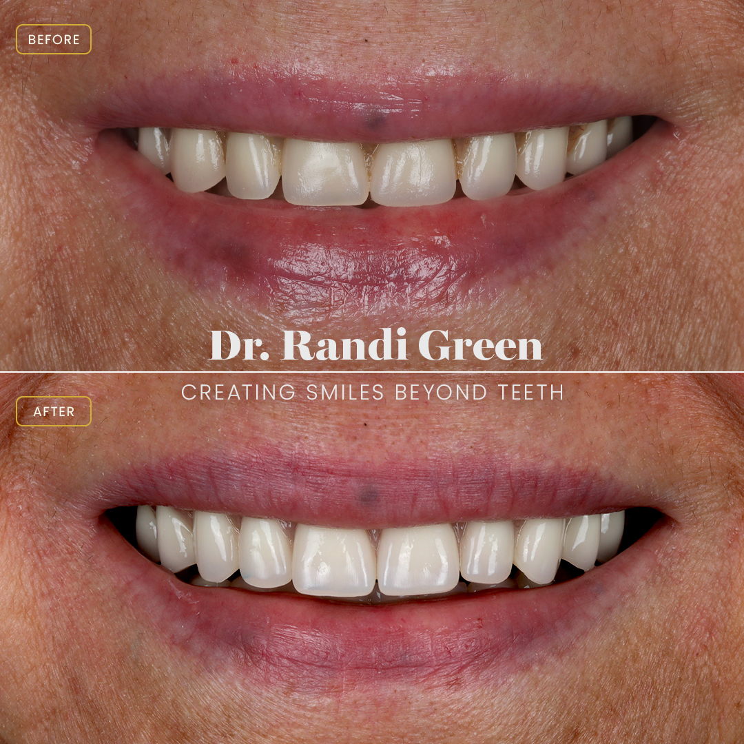 High-Quality Cosmetic Dentures with Dr. Green - Springfield Smile Doctor