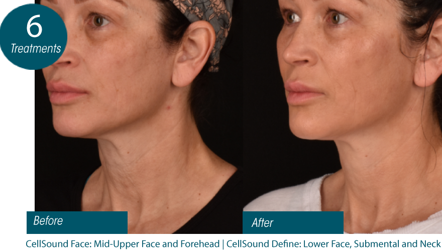CellSound Aesthetics® | Anti-Aging & Contouring
