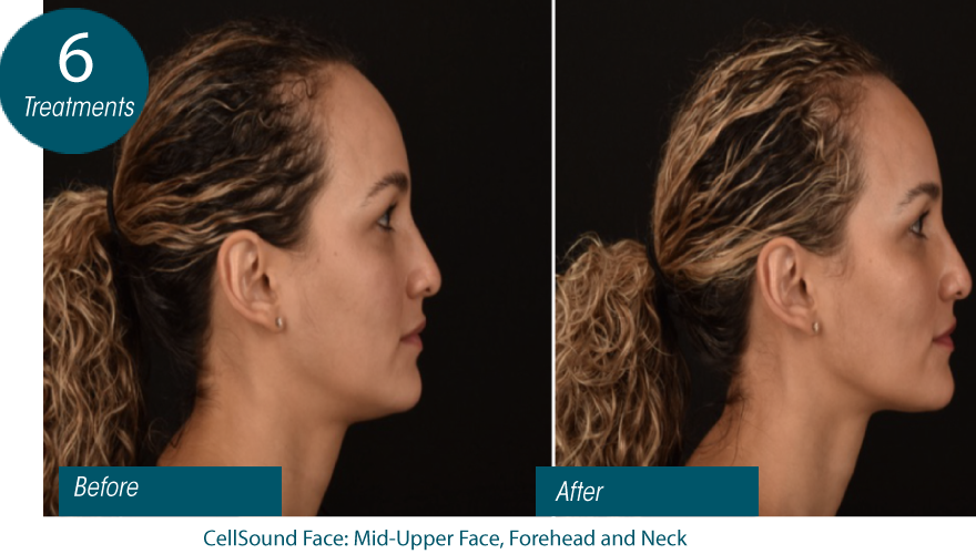 CellSound Aesthetics® | Anti-Aging & Contouring