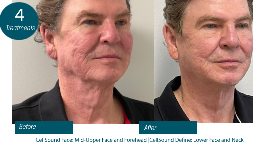CellSound Aesthetics® | Anti-Aging & Contouring