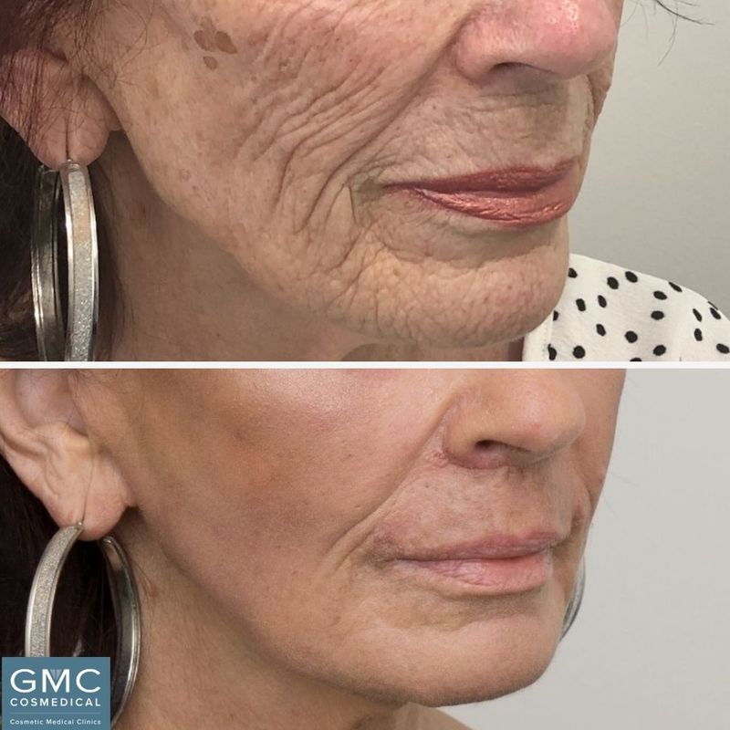 GMC Cosmedical | Laser, skin and injectables | Australia