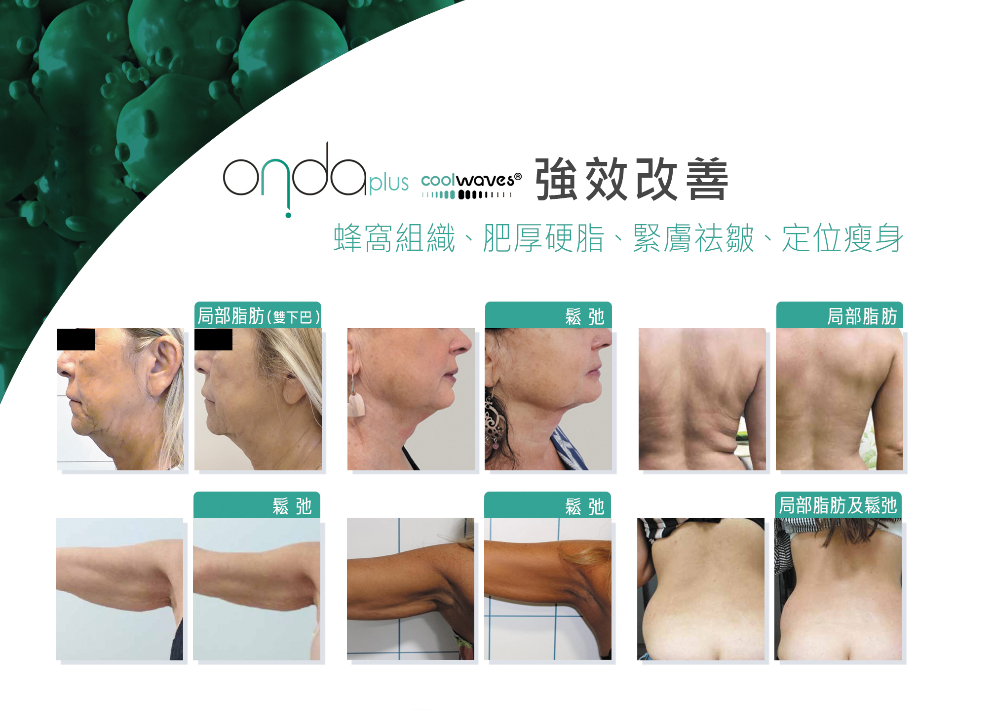 ONDA PLUS 一叮溶脂($780/部位) - Homage SkinLab 專業美容中心