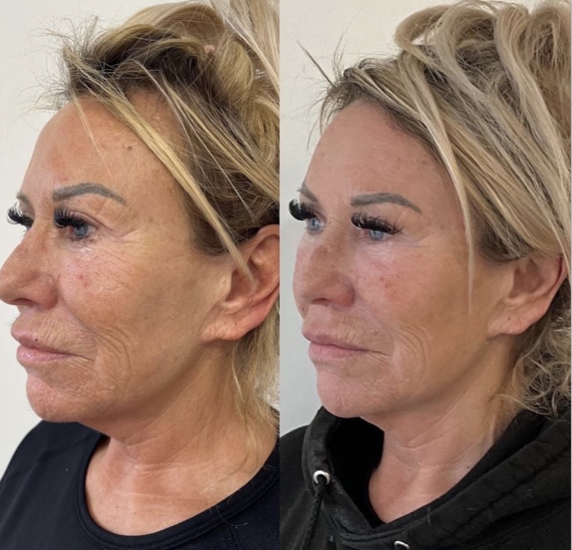 The benefits of Morpheus 8 treatment