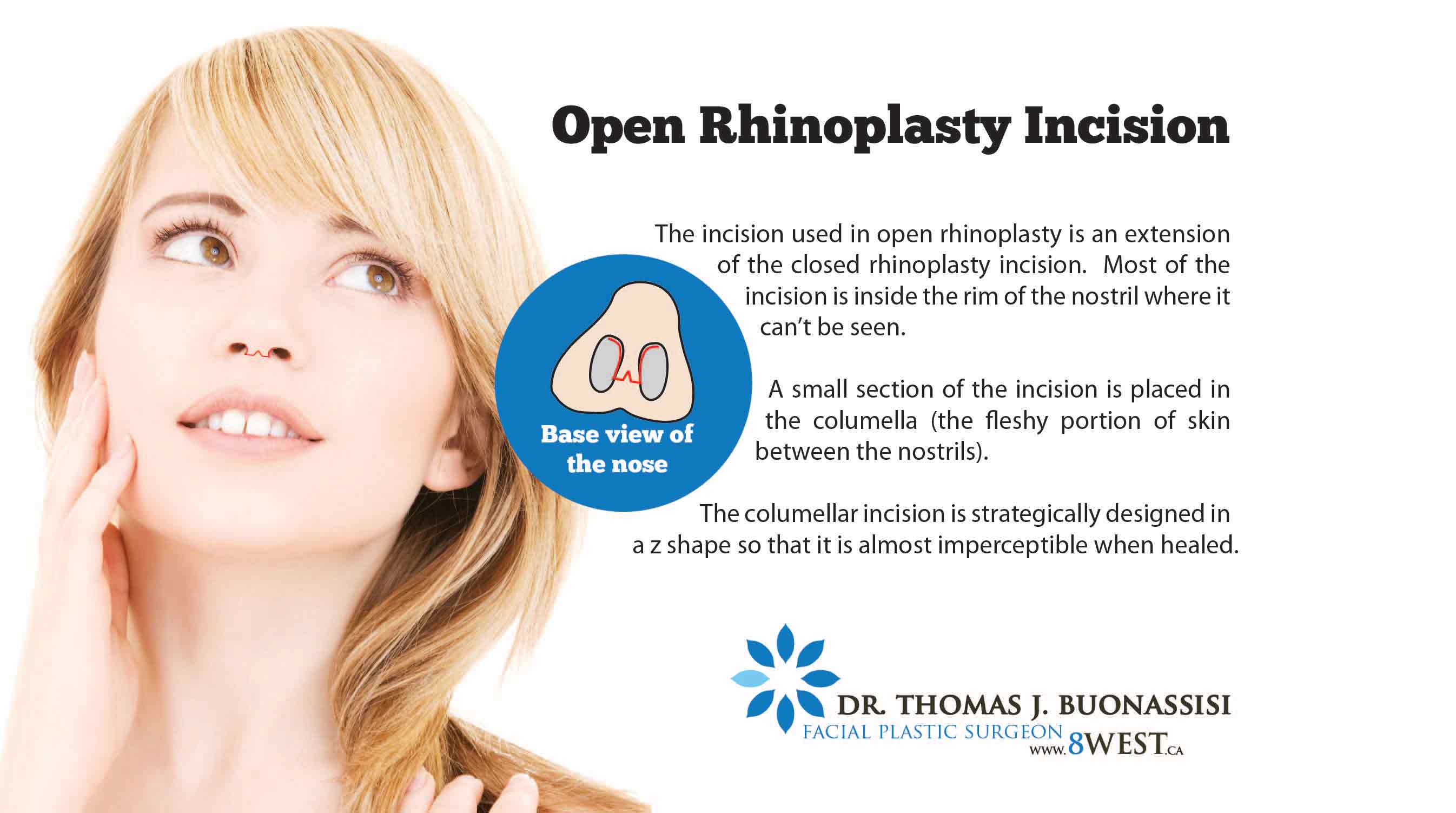 Where Are Open Rhinoplasty Incisions Placed? - 8 West Cosmetic Surgery ...