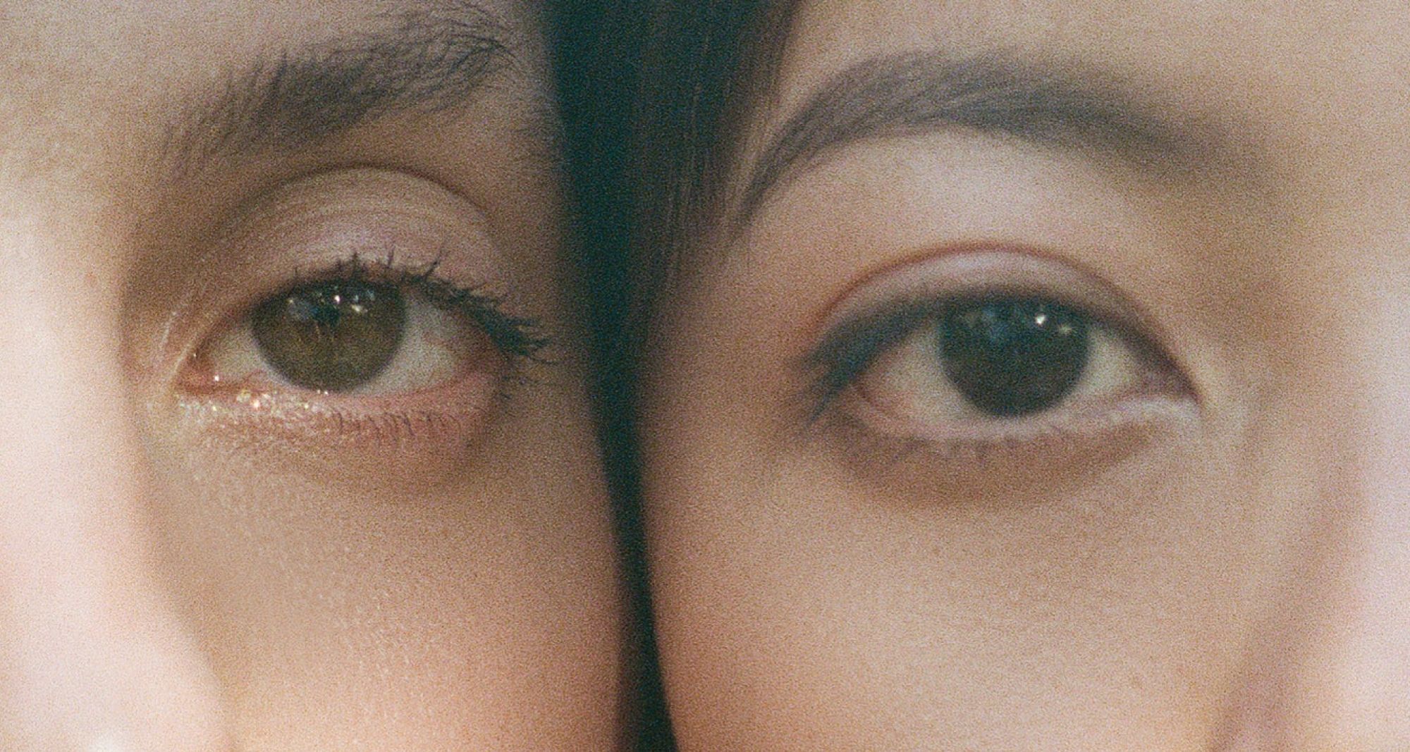 What is a Short Incision Facelift? - 8 West Cosmetic Surgery Clinic BC