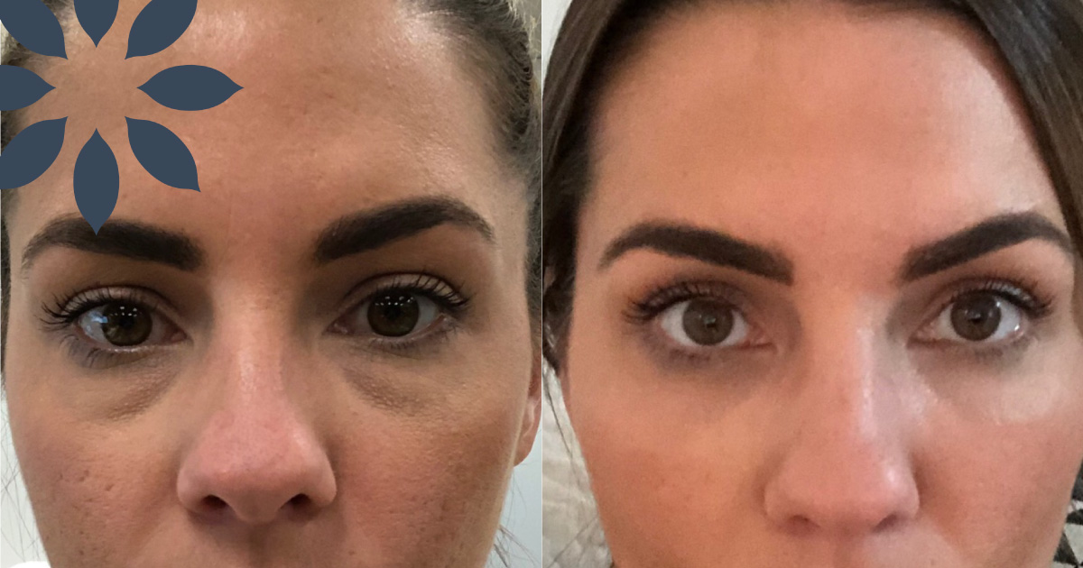Tear Trough Rejuvenation with Dermal Filler Before & After Photos | 8 ...