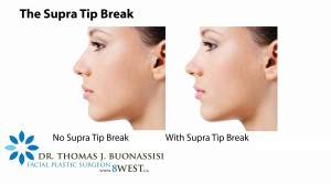 The Coveted Supra Tip Break. What Is It? - 8 West Cosmetic Surgery ...