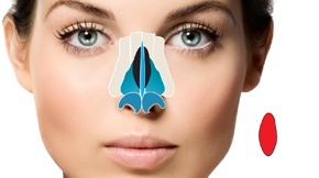 What Is an Open Roof Deformity and How Is It Avoided? - 8 West Cosmetic ...