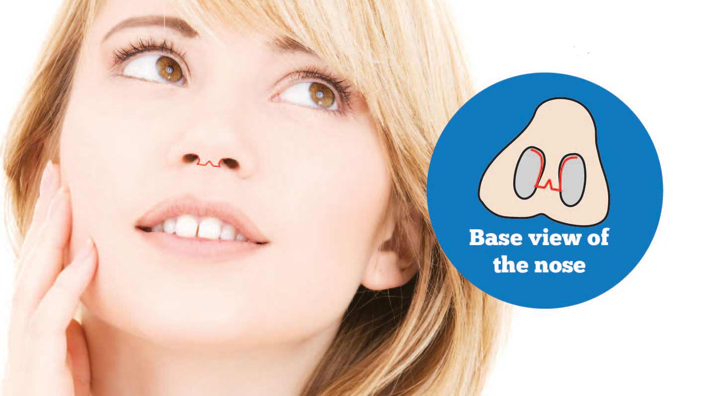 Where Are Open Rhinoplasty Incisions Placed? - 8 West Cosmetic Surgery ...