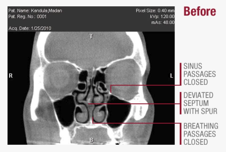 Chronic Sinus Issues: When the Doctor Becomes the Patient