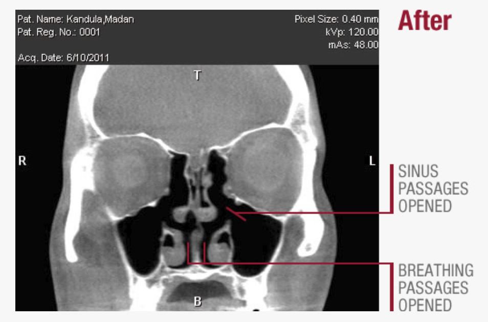 Chronic Sinus Issues: When the Doctor Becomes the Patient