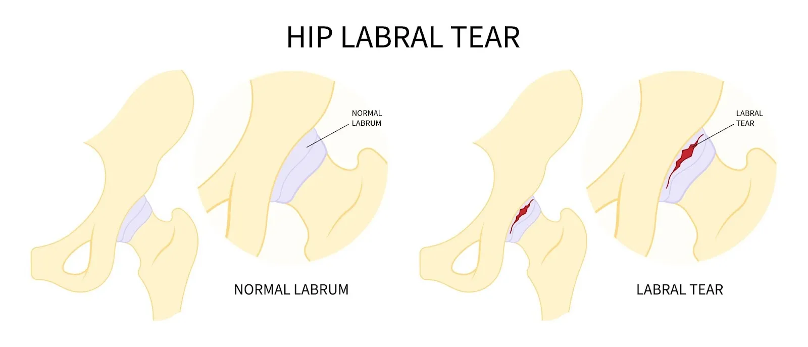 Hip Labral Injuries