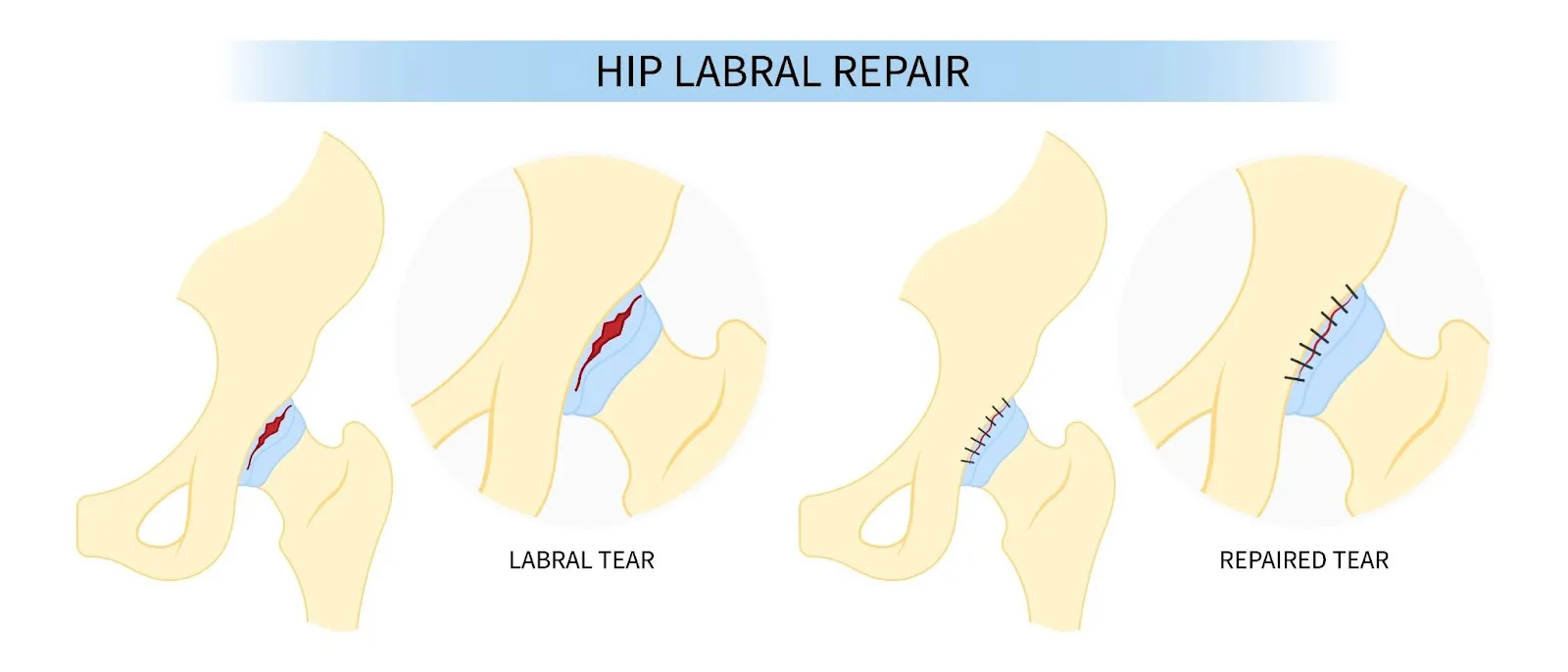 Hip Labral Injuries