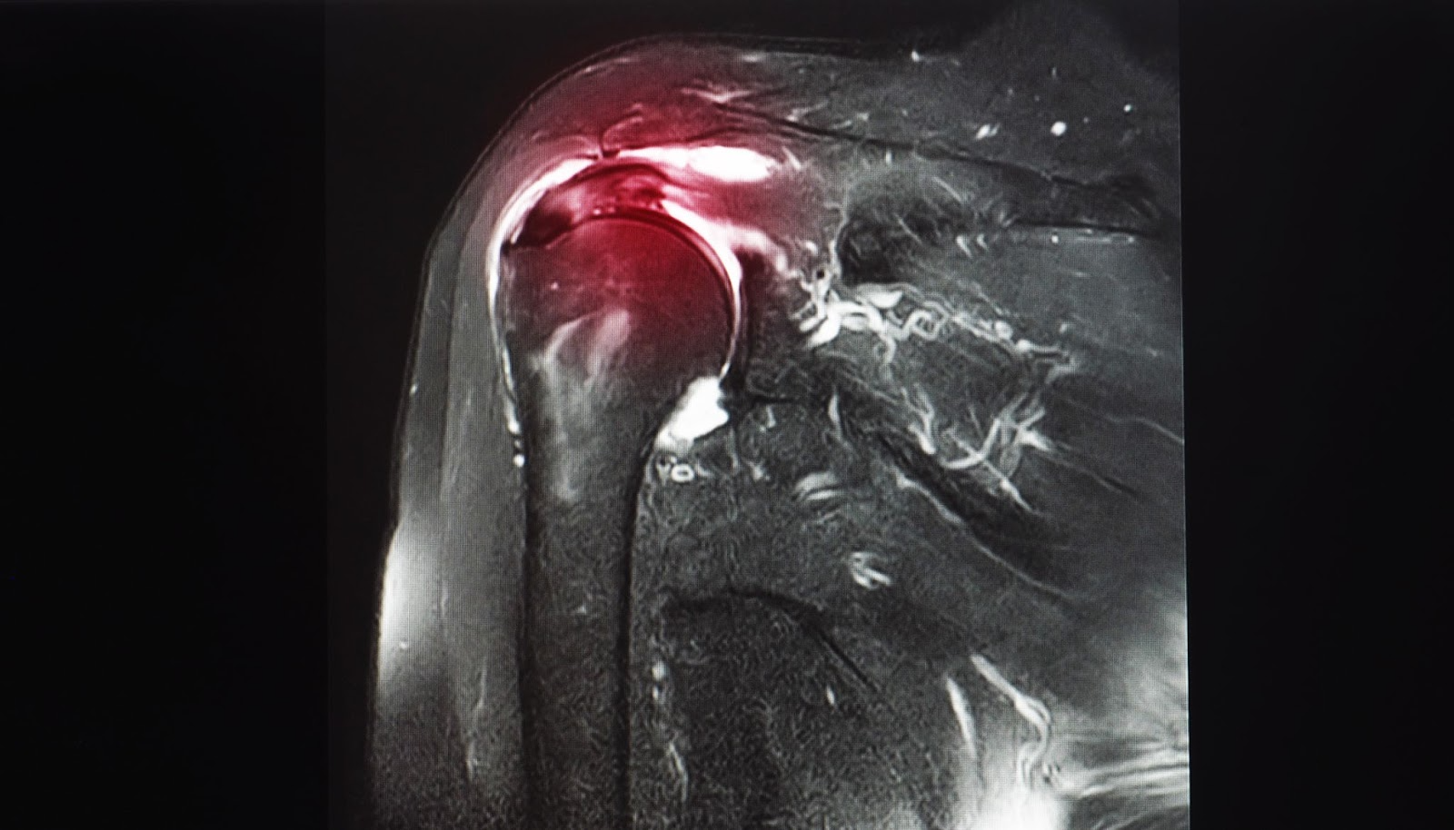 Glenoid Labrum Tear