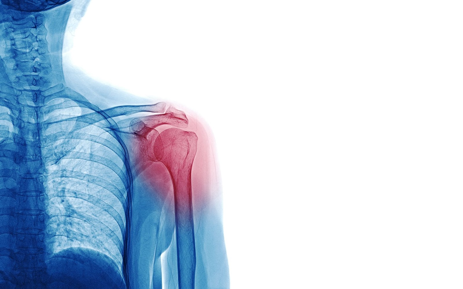 Shoulder Tendonitis