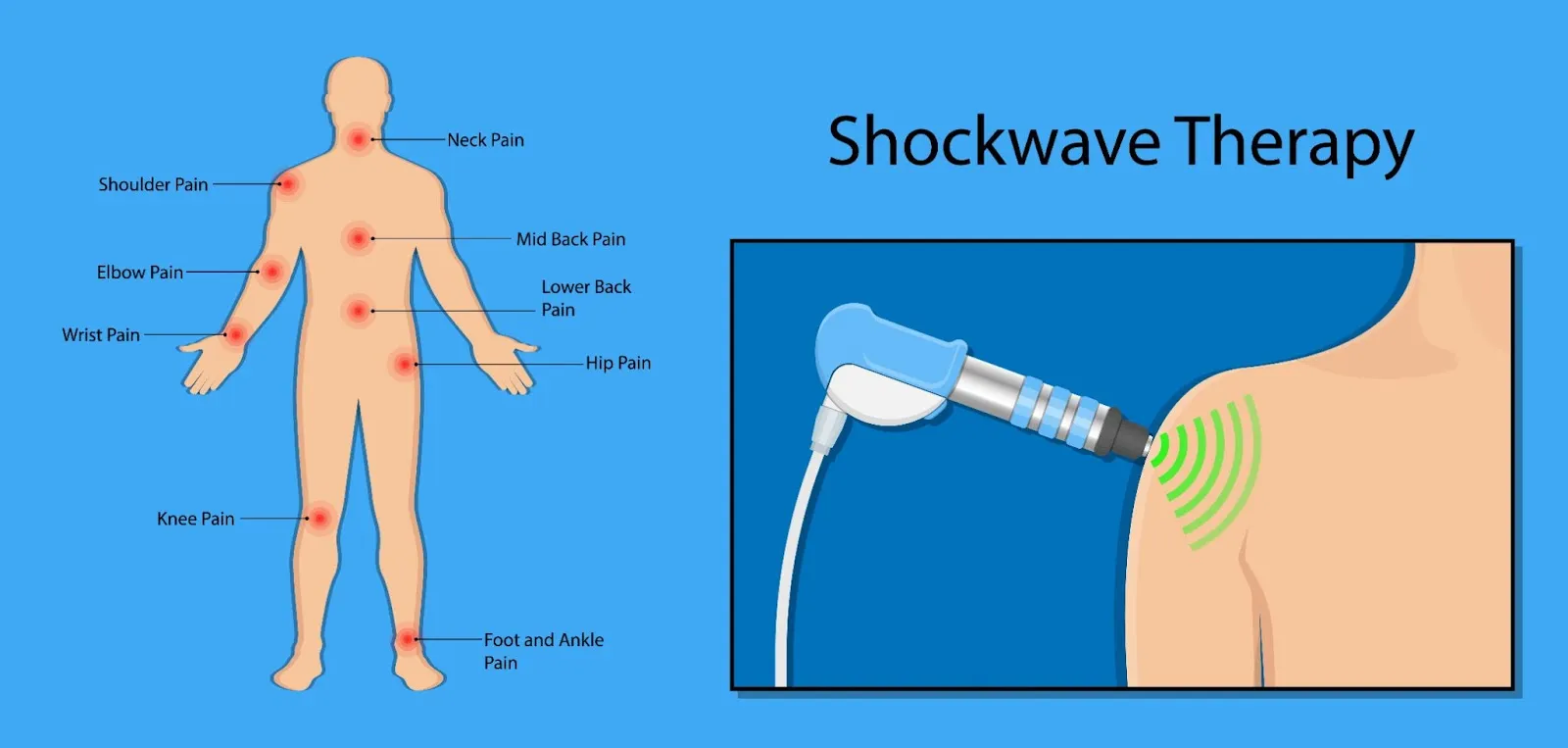 FOCUSED Shockwave Therapy / FOCUSED ESWT