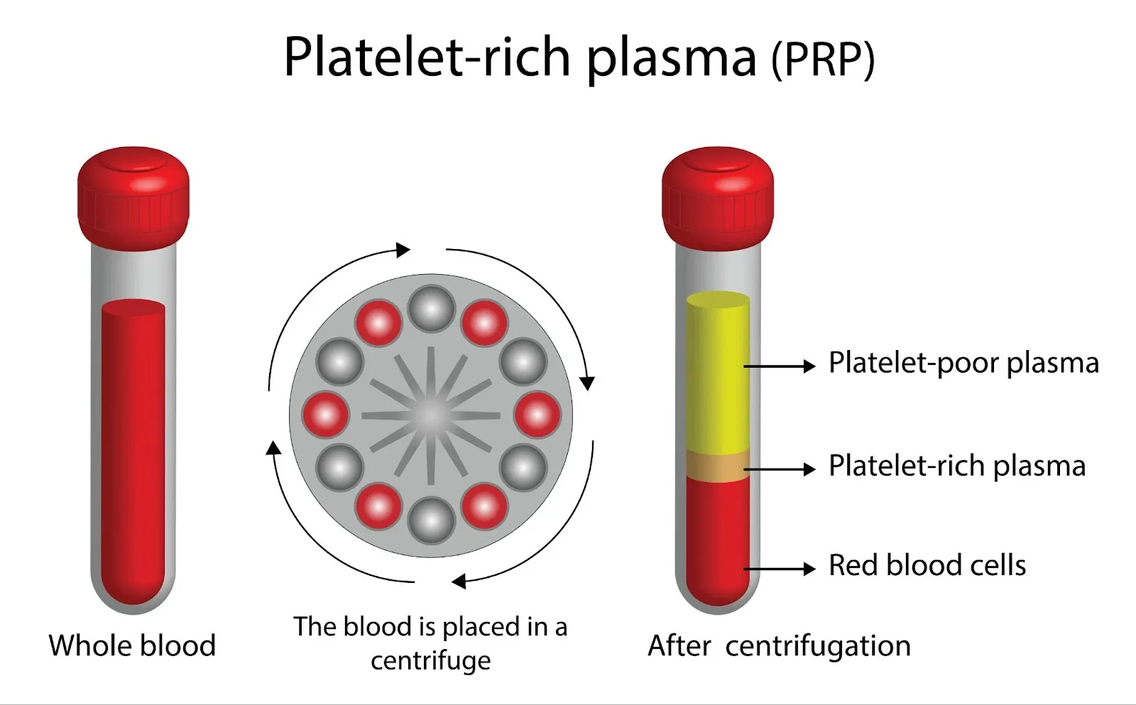 Platelet-Rich Plasma (PRP) Injection