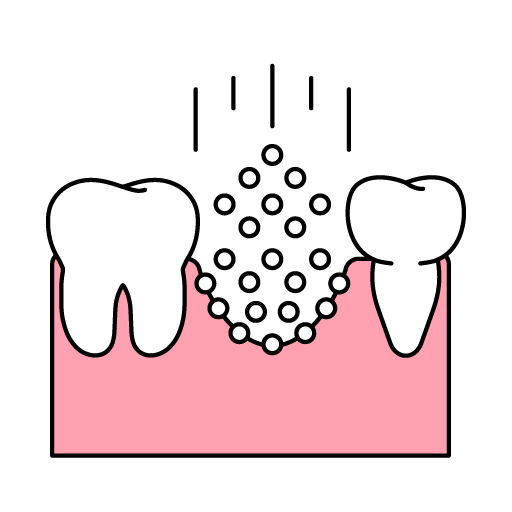 La guía completa del procedimiento Injerto óseo