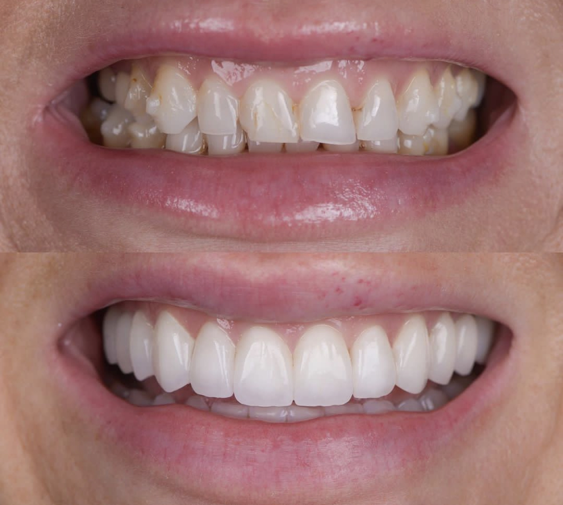 Before and After Portfolio | Smile Enhancement