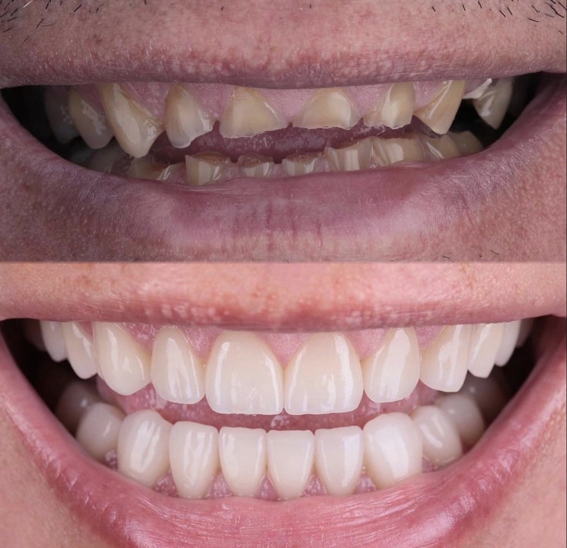 Fijación de la dimensión vertical | Bruxismo dental