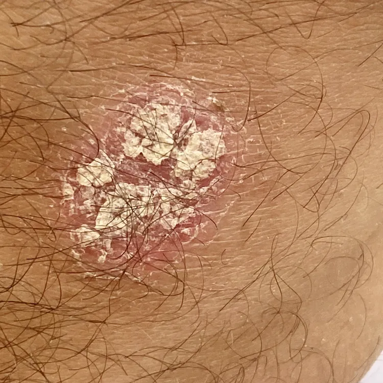 Tratamiento para la Psoriasis en Madrid | DERMANIAC, Clínica ...