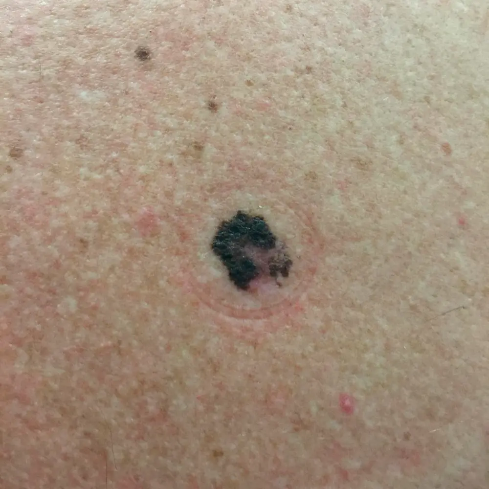 Extirpación de nevus | DERMANIAC, Clínica dermatológica y estética