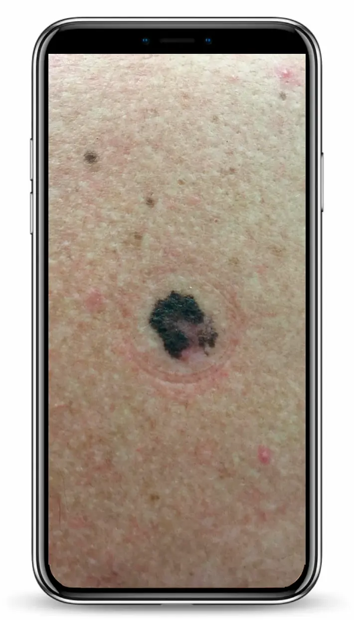 Extirpación de nevus | DERMANIAC, Clínica dermatológica y estética