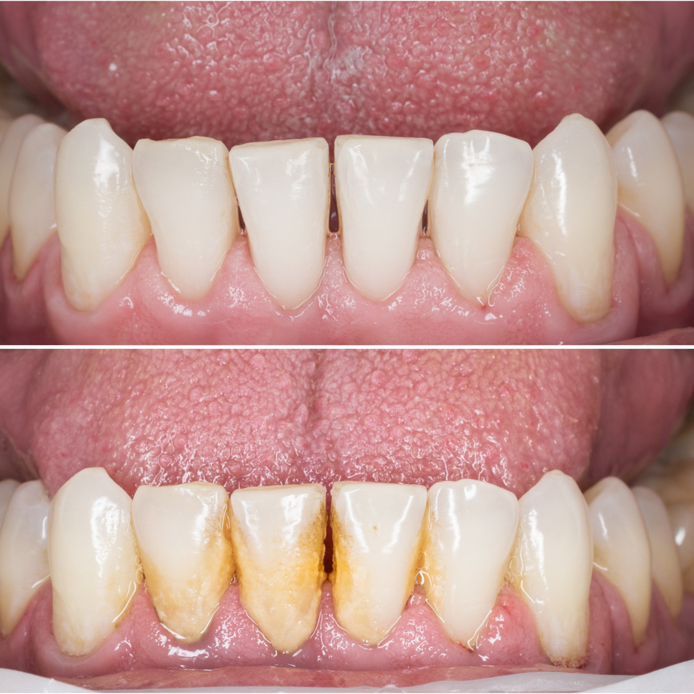 Whitening & Stain Removal - Bespoke Smiles Wanaka | Dentist in Wanaka