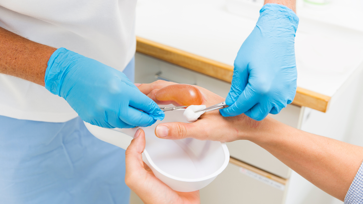 First Aid Essentials: How to Treat a Burn at Home