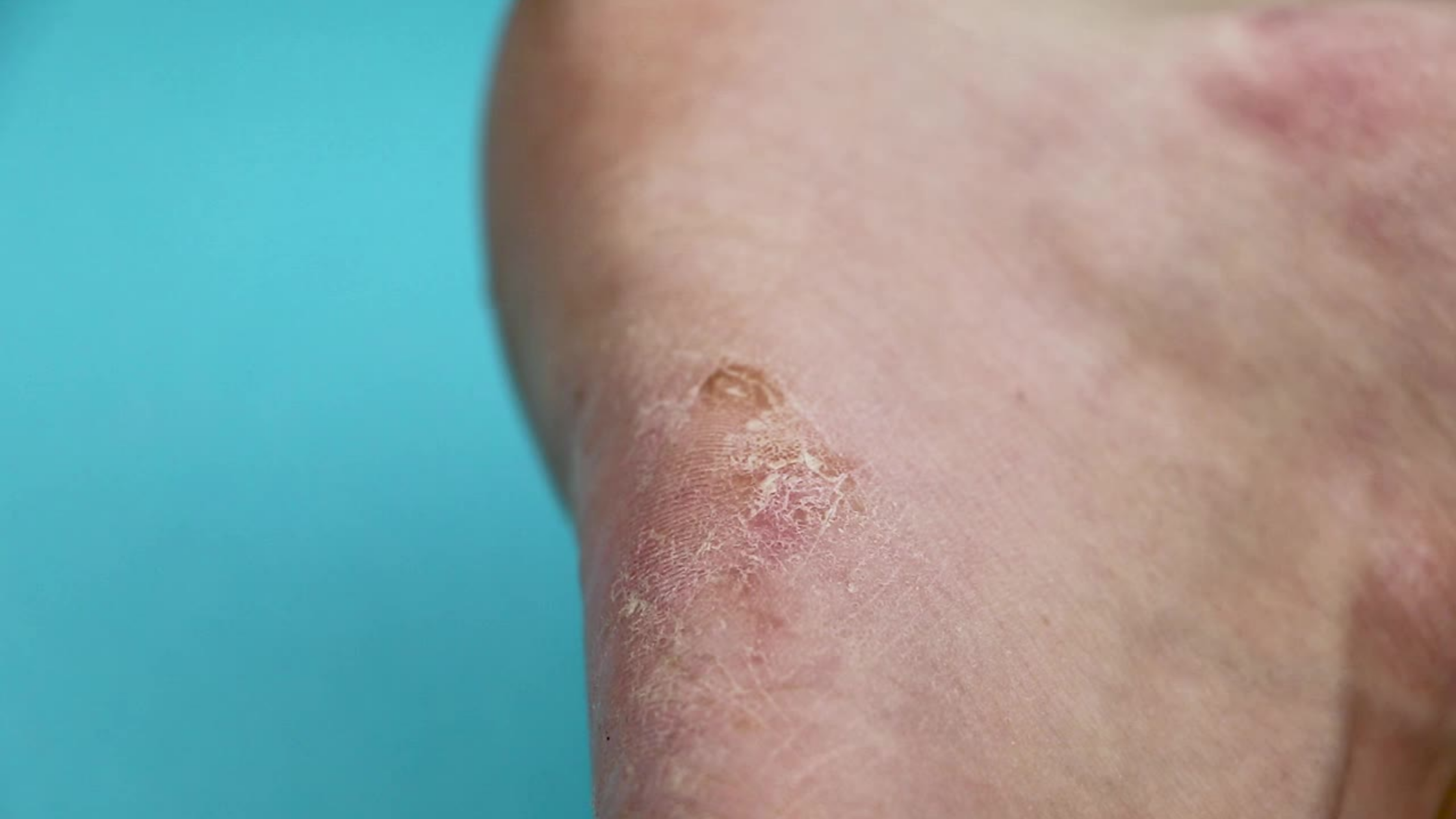 Cellulitis: A Comprehensive Guide to Recognizing and Understanding This ...