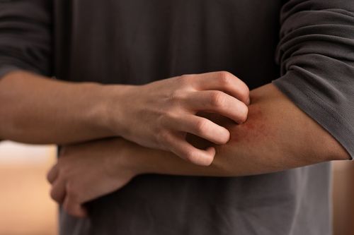 Alcohol Allergy Rash: Effective Remedies