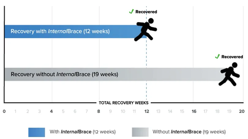 InternalBrace ligament augmentation repair