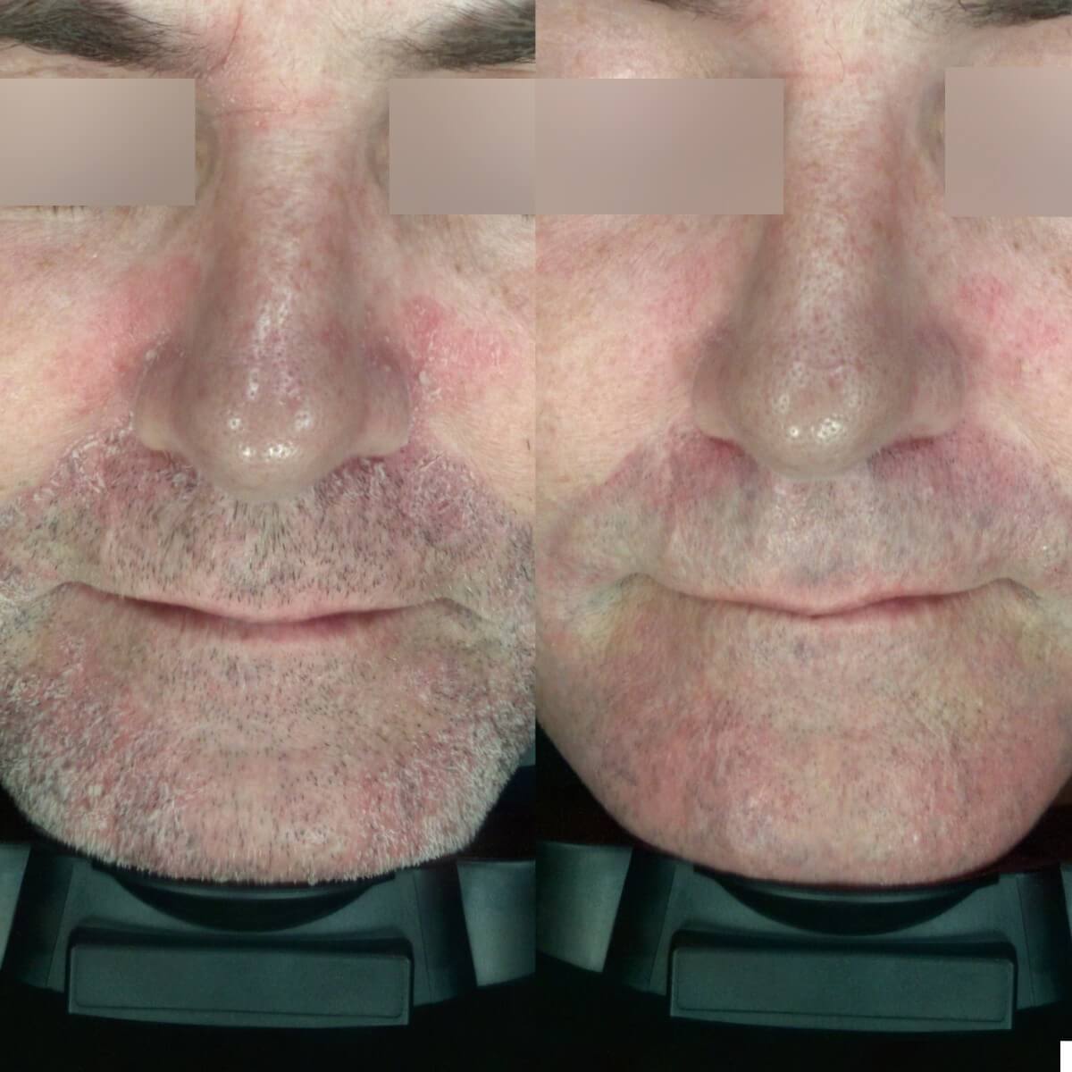 Treating Eczema - Managing Eczema | Hawthorne Skin & Beauty