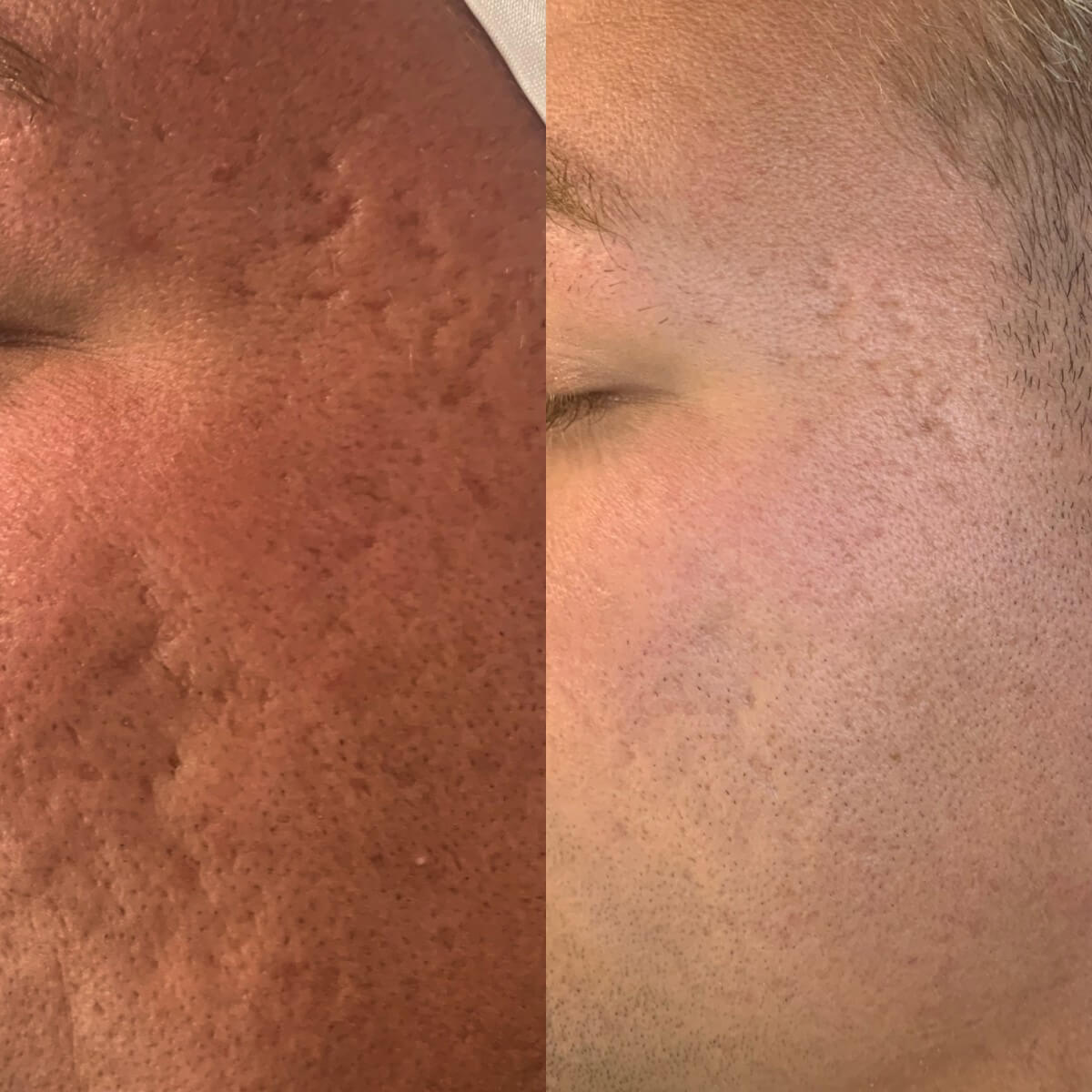 Acne Scar Treatments - Treating Acne Scarring | Hawthorne Skin & Beauty