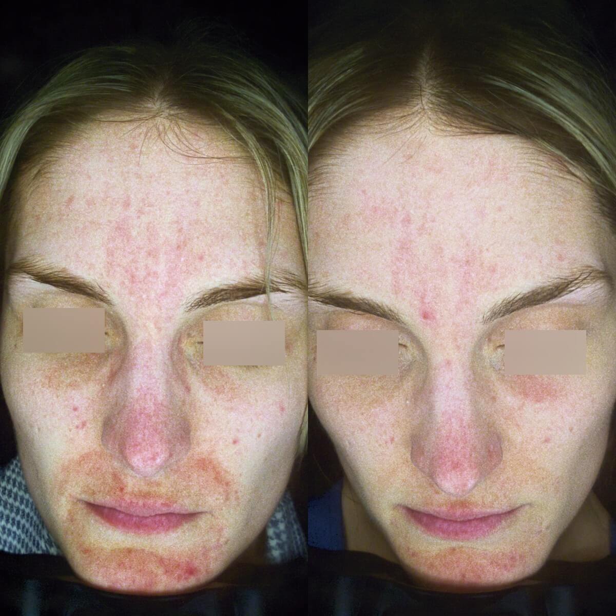 Skincare for Sensitive Skin - Treatments for Sensitive Skin | Hawthorne ...