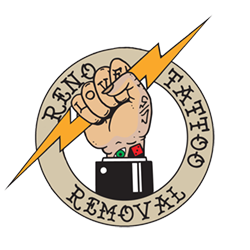 Reno Laser Tattoo Removal - Serving the Reno and Tahoe area