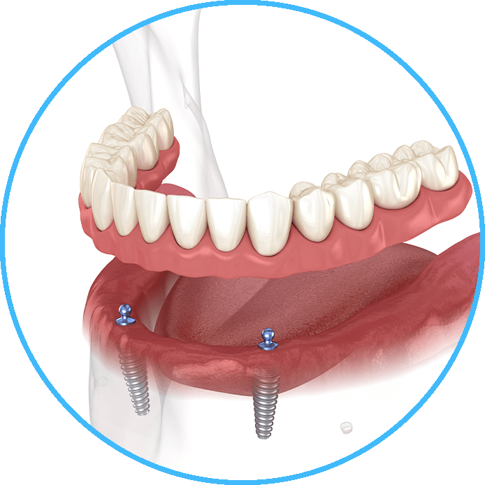 Implant Supported Dentures in Houston, TX | Dr. Friedberg