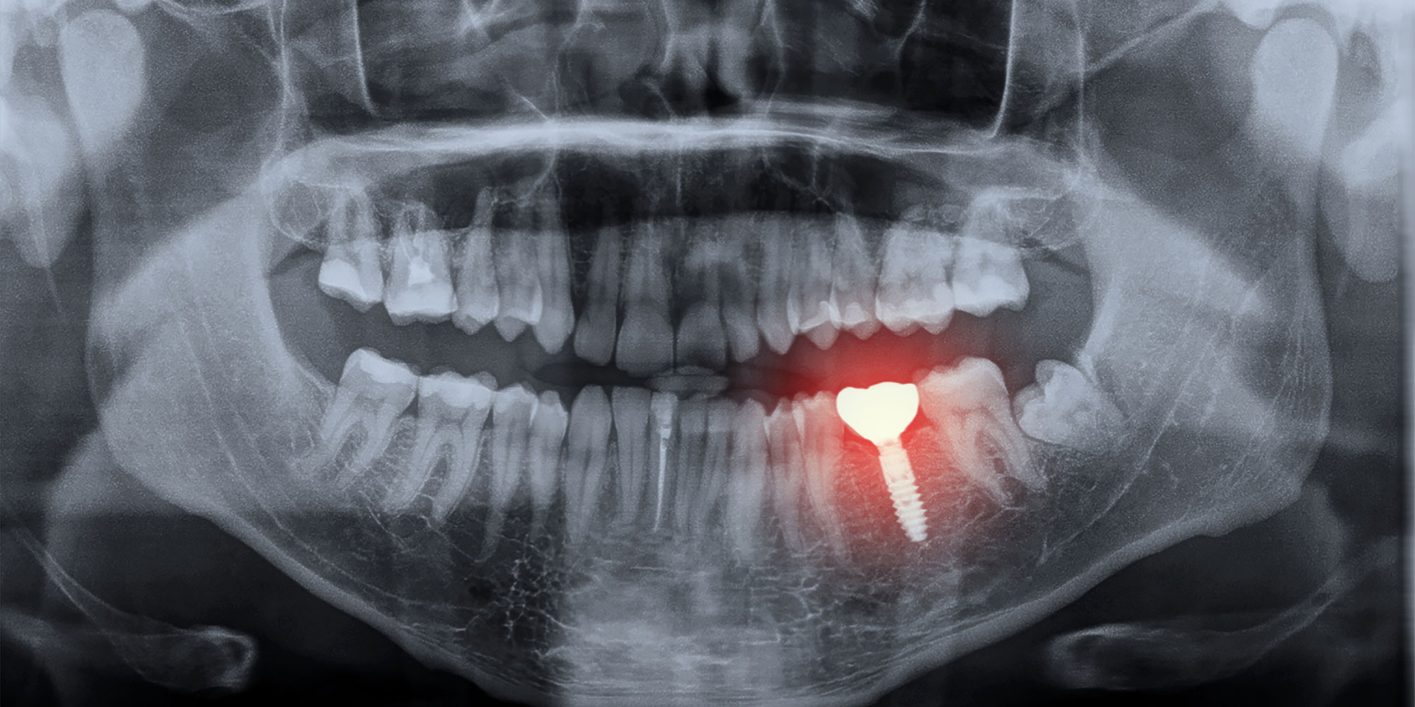 Single Missing Tooth | Dental Implants | Houston, TX