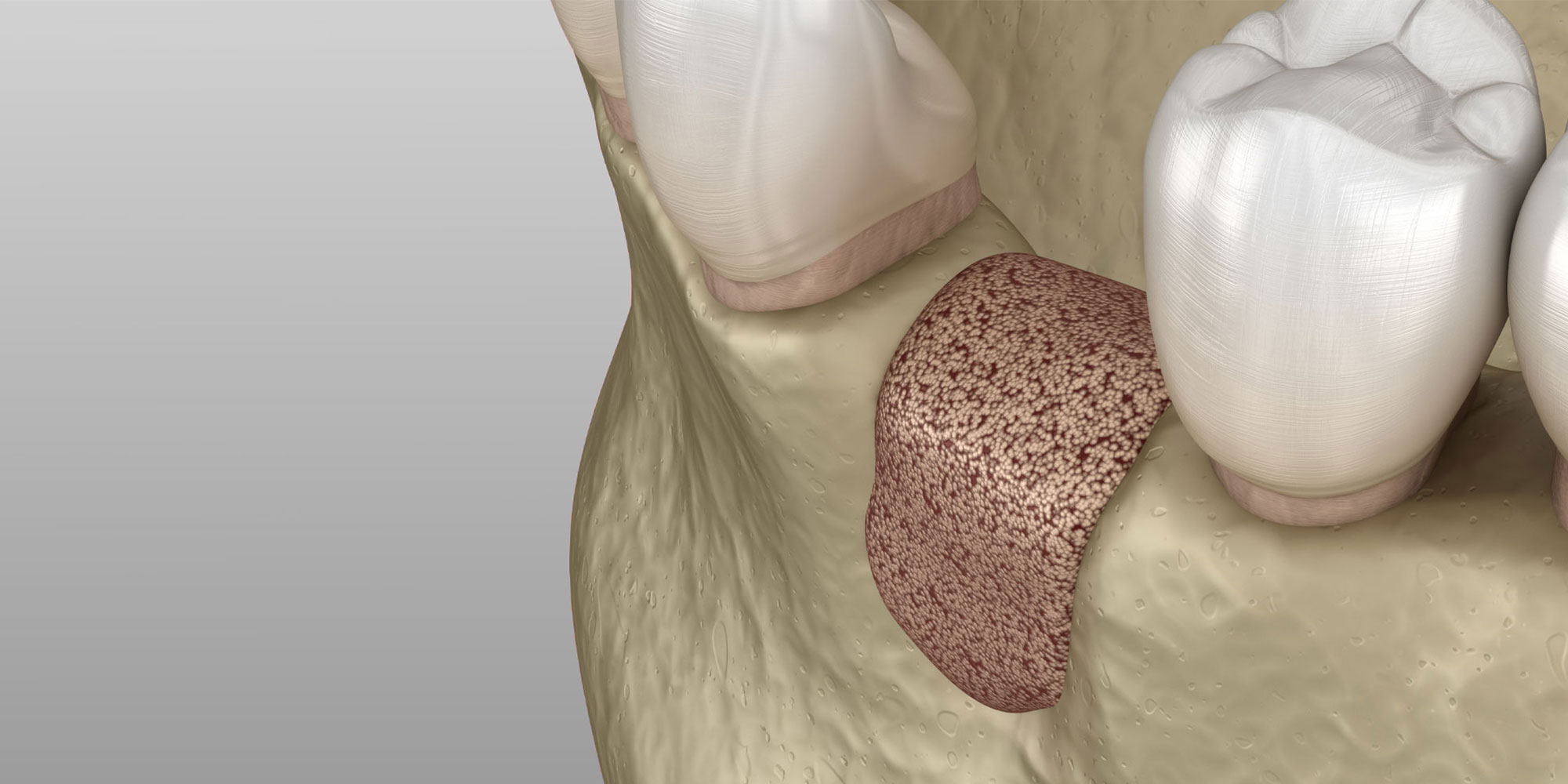 Oral Surgery Houston TX | Dr. Friedberg & Associates